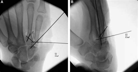 Displaced And Comminuted Fracture Of The Bases Of The Fourth And Fifth Download Scientific