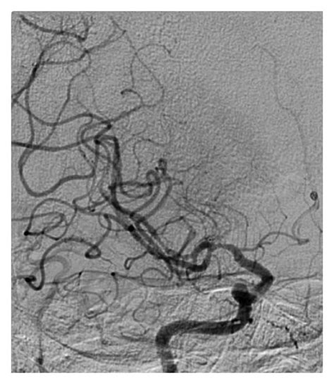 A Angiogram Shows A Thrombus On Proximal Mca And An Occlusion Of