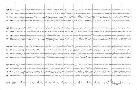 EEG Showed Mild Diffuse Slowing With Inordinate Amounts Of Arrhythmic Download Scientific