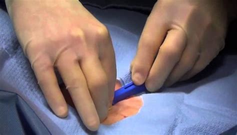 What Is The Loop Recorder Discovering Home Telemetry