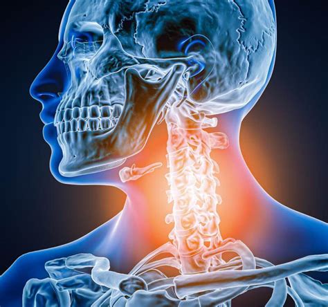 Cervical Disc Arthroplasty Royal Spine Surgery