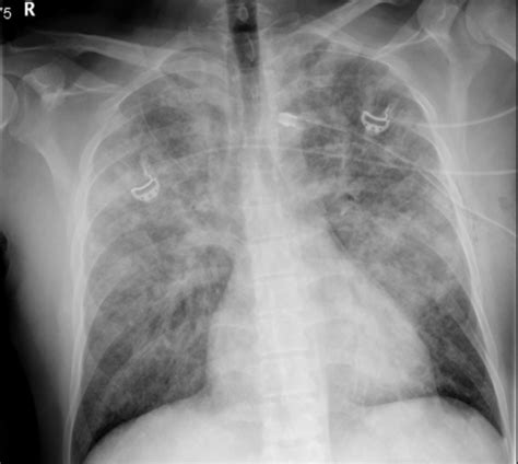 Chest X Ray Diffuse Bilateral Pulmonary Vascular Cong