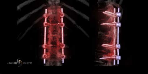 Si Joint Fusion In Plano Tx Advanced Spine Center