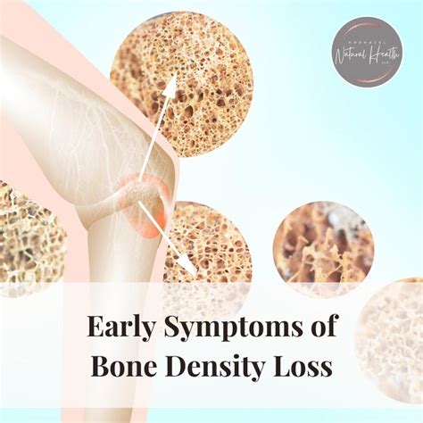 Bone Density Loss Signs And Symptoms Gwen Krehbiel Posted On The