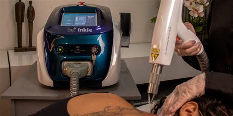 Processo de remoção de tatuagem como funciona