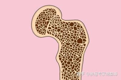 得了骨癌能活多久让杨院长来为你解答 知乎