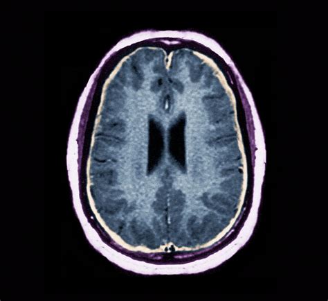 Bacterial Meningitis Mri Scan Photograph By Science Photo Library Pixels