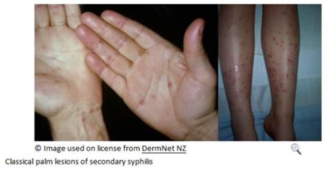 13 Syphilis Flashcards Quizlet