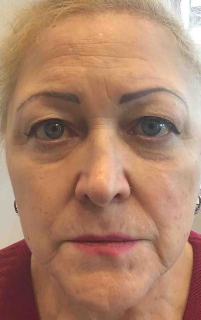 Dermal Fillers Before And After Photos New York Laser Vision