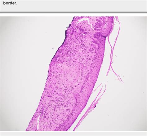 Figure 2 From Granuloma Annulare Mimicking Squamous Cell Carcinoma