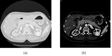 2 A Cross Sectional Ct Scan Image B Cross Sectional Ct Scan Image Download Scientific