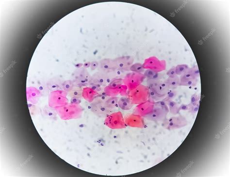 Premium Photo Paps Smear Under Microscopy Showing Inflammatory Smear