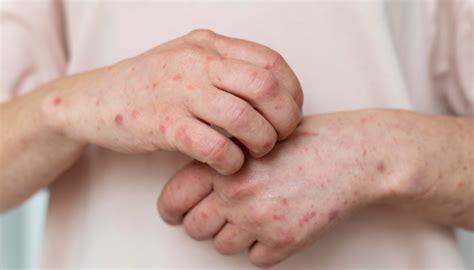 Fda Approves Berdazimer Gel Breakthrough For Molluscum Contagiosum