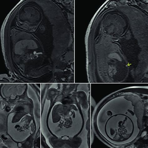 Pdf Meconium Peritonitis