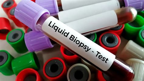 Qué Es La Biopsia Líquida Y Qué Tipo De Tumores Puede Detectar