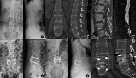 A 56 Year Old Female Patient Underwent Transforaminal Lumbar Interbody Download Scientific