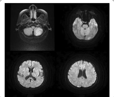 Mri Brain Axial Dwis Show Left Inferior Cerebellar Left Occipital And