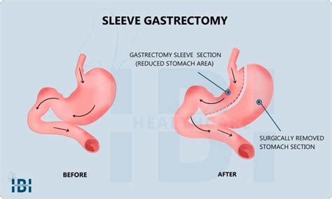 Sleeve Gastrectomy Vs Gastric Bypass