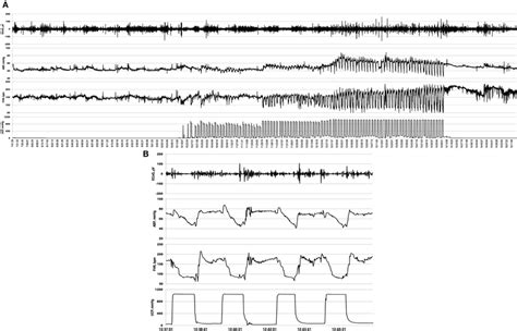 Example Of An Individual Electrocorticogram Ecog Response To