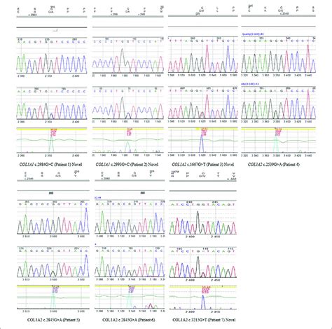 Sanger Sequencing Chromatograms Of All Identified Variants Reported