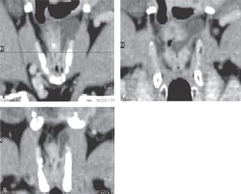 Laryngocele Radiology Key