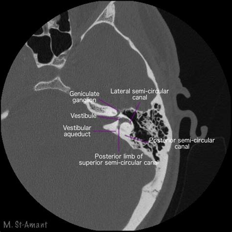 Radiopaedia Case Inner Ear Anatomy Annotated Ct Id Study Nc Commons