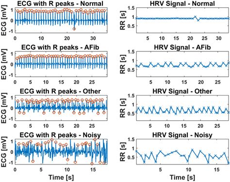 Preprocessed Ecg Recordings With Detected R Peaks And Corresponding Hrv
