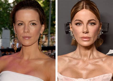 Celebrity Plastic Surgery Before And After Reddit