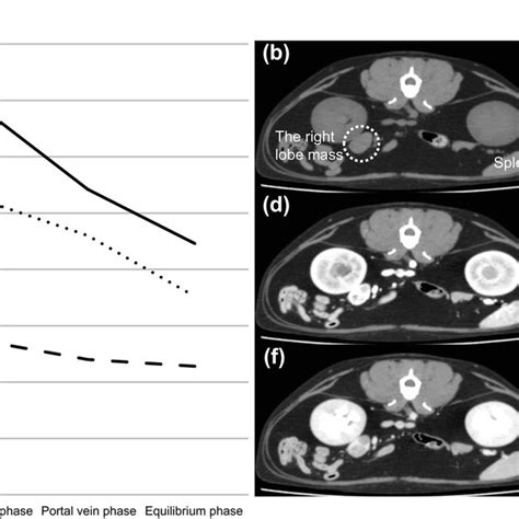 Hyper Attenuation Of The Right Lobe Mass In The Normal Surrounding