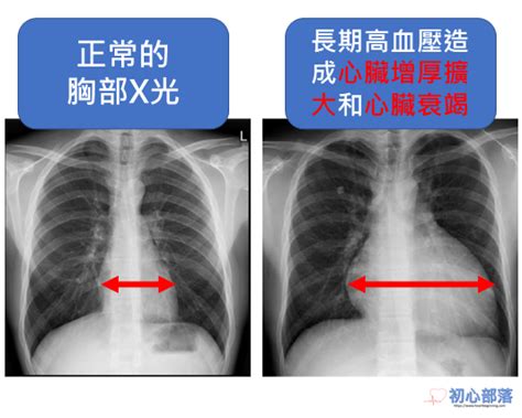 高血壓對身體的危害