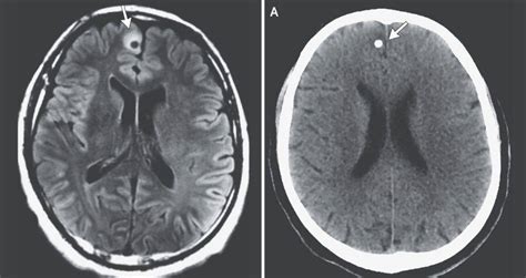 Boston Mans Mysterious Seizures Caused By Tapeworms In His Brain
