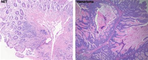 Representative Biopsy Histologic Slides Of The Two Most Common Small