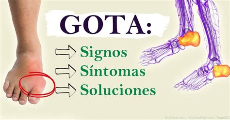 Cuáles son los síntomas de la gota Señales a las cuales estar atento