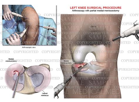 Arthroscopy Of Left Knee With Partial Medial Meniscectomy Medical Art