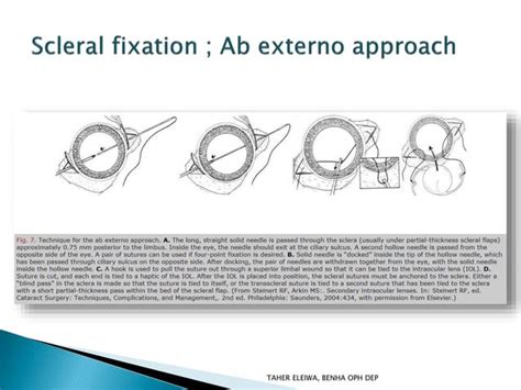 Secondary Iol Implantation Pptx