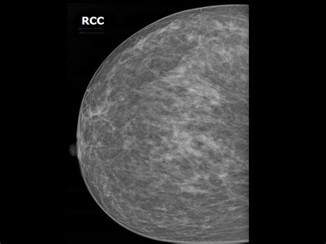 Atlas Of Breast Cancer Early Detection