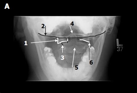 Open Mouth Odontoid Diagram Quizlet Open Mouth Odontoid Diagram Quizlet