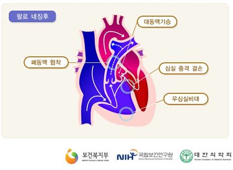 팔로 네증후 팔로사징후 Tetralogy Of Fallot 폐동맥 판막 심장판막 재수술 네이버 블로그