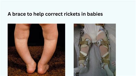 How To Treat Rickets 4 Possible Approaches