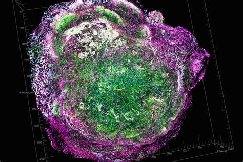 Ai Speeds Up Design Of New Antibodies That Could Target Breast Cancer