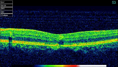 Two Months After Recurrence Subretinal Fluid Is Absorbed Download Scientific Diagram
