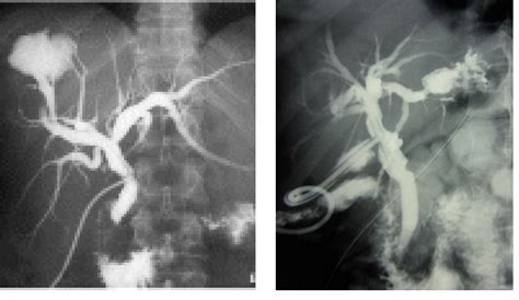 Hydatid Cysts Of The Liver Diagnosis Complications And Treatment
