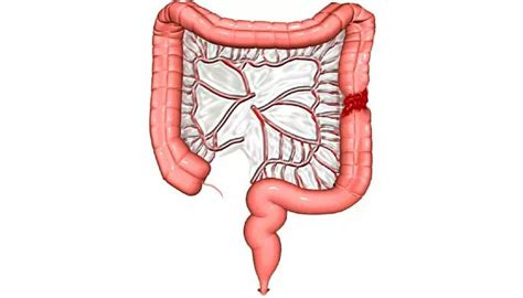 What To Expect From Partial Colectomy