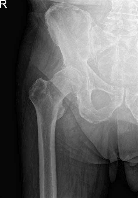 Estudio de caso Artroplastia total primaria de cadera en una mujer de años con artritis de