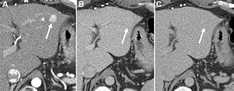 Typical Appearance Of A Benign Fnh Like Lesion Small Download