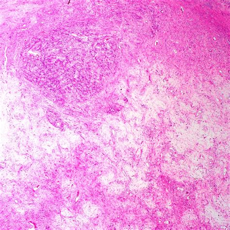 Pathology Outlines Angiomyofibroblastoma