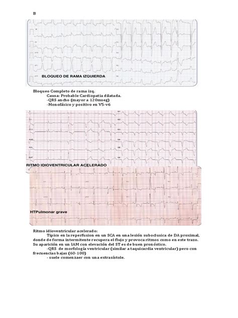 Ejemplos De Electrocardiogramas Pdf