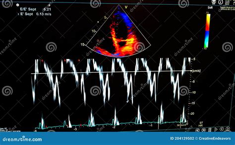 Doppler Echocardiogram Showing A Four Chamber View Editorial Photography Illustration Of