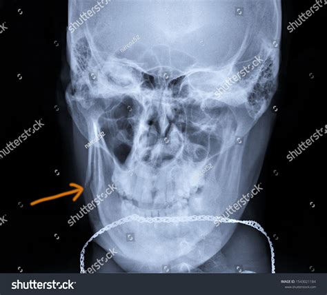 Dislocated Jaw X Ray