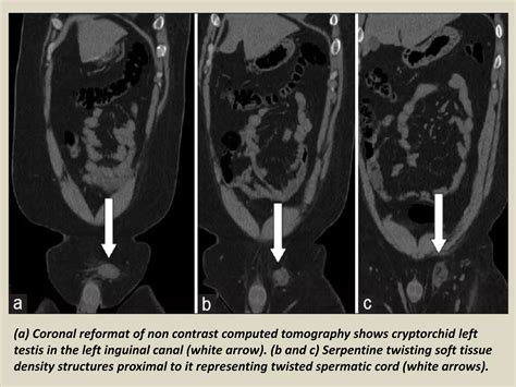Presentation1 Radiological Imaging Of Undescended Testis Pptx